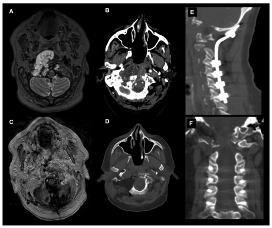 Craniovertebral Junction Instability after Oncological Resection: A ...