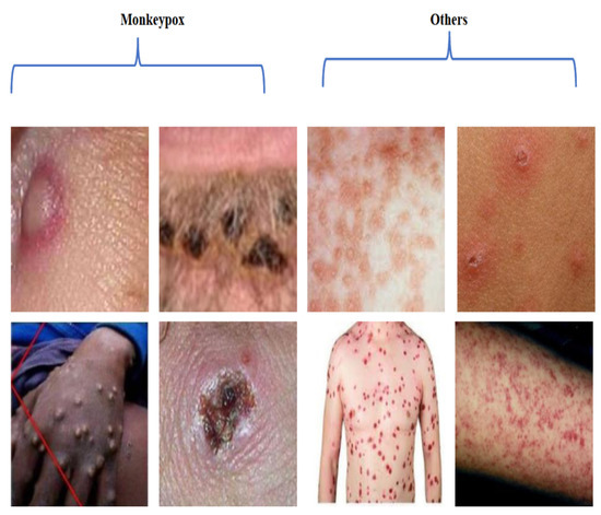 A Transfer Learning Approach for Clinical Detection Support of Monkeypox Skin Lesions