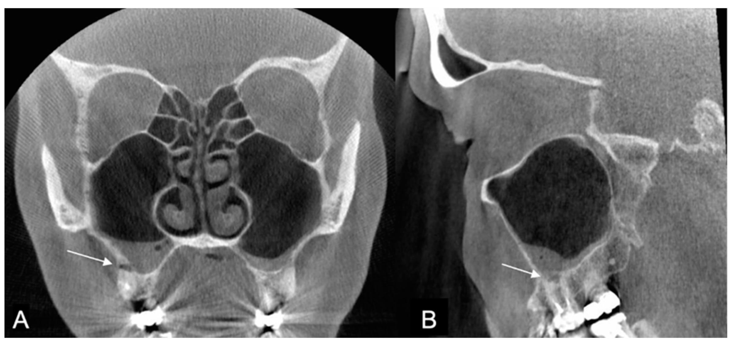 Retrospective Analysis of Artifacts in Cone Beam Computed Tomography ...