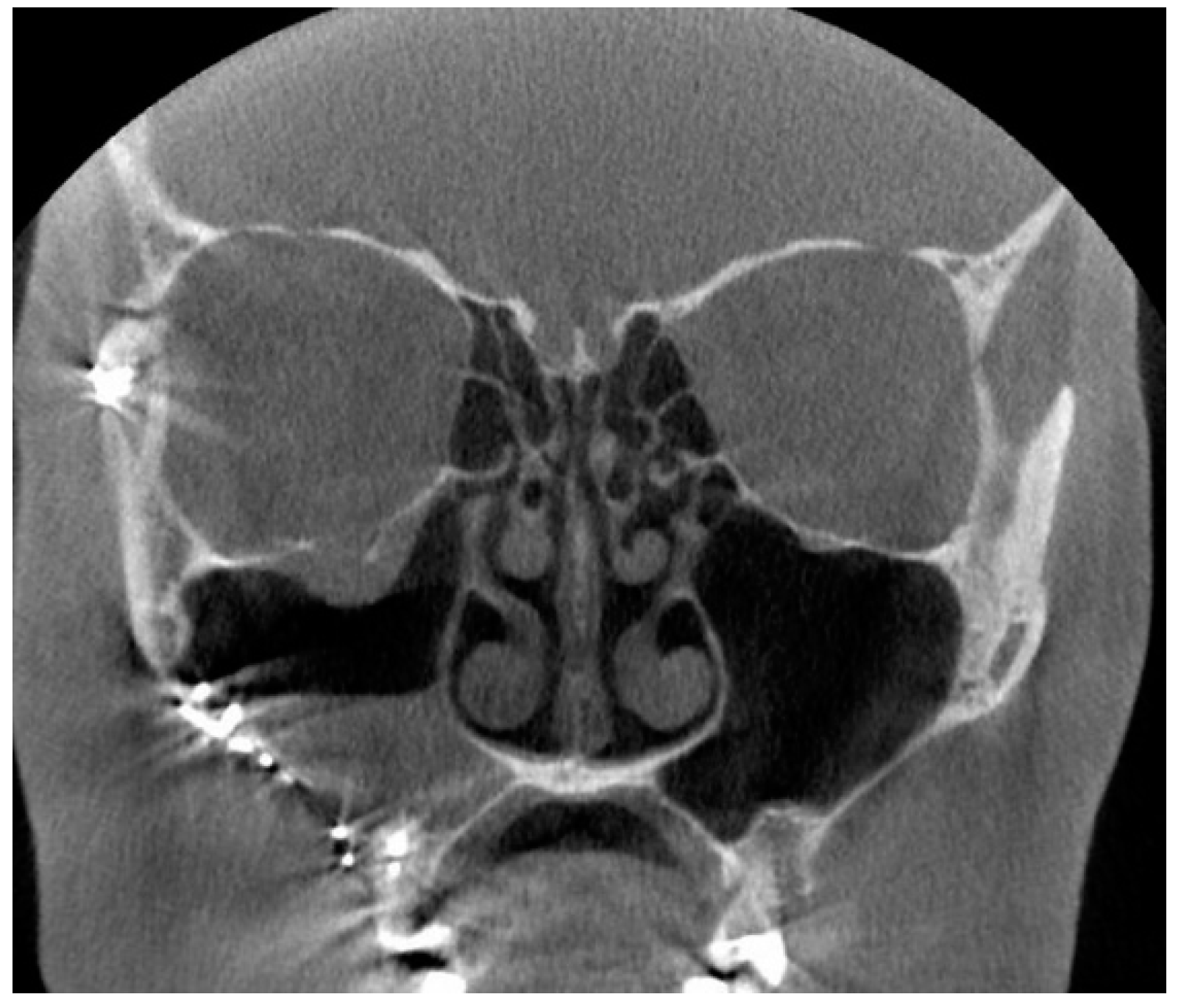 Retrospective Analysis of Artifacts in Cone Beam Computed Tomography ...