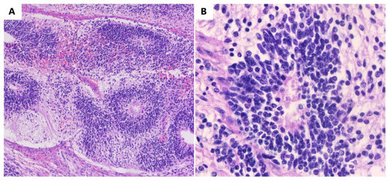 Immature Teratoma: Diagnosis and Management—A Review of the Literature