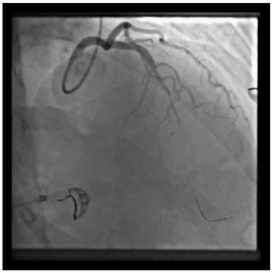 Chronic or Changeable Infarct Size after Spontaneous Coronary Artery ...