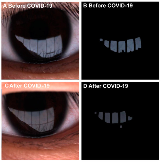 Investigating the Impact of COVID-19 Infection on Dry Eye Parameters
