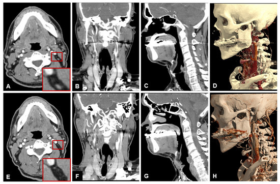 Ultra-High-Resolution CT of the Head and Neck with Deep Learning ...