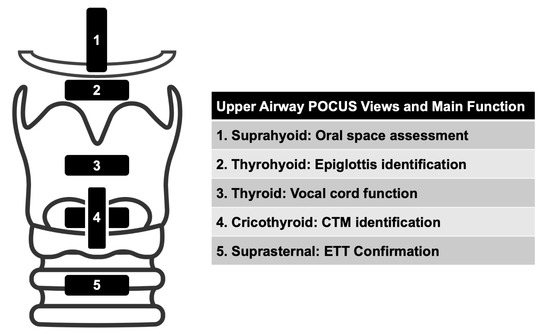 Point-of-Care Ultrasound in Airway Evaluation and Management: A ...
