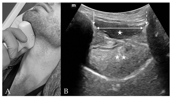 Point-of-Care Ultrasound in Airway Evaluation and Management: A ...