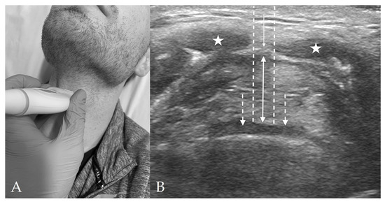 Point-of-Care Ultrasound in Airway Evaluation and Management: A ...