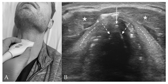Point-of-Care Ultrasound in Airway Evaluation and Management: A ...
