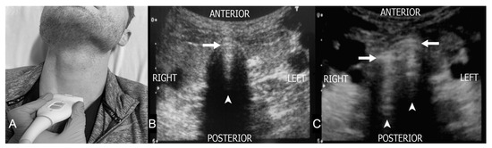 Point-of-Care Ultrasound in Airway Evaluation and Management: A ...