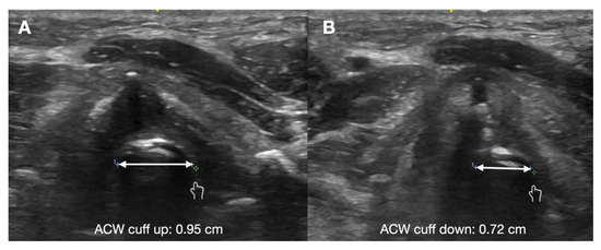 Point-of-Care Ultrasound in Airway Evaluation and Management: A ...