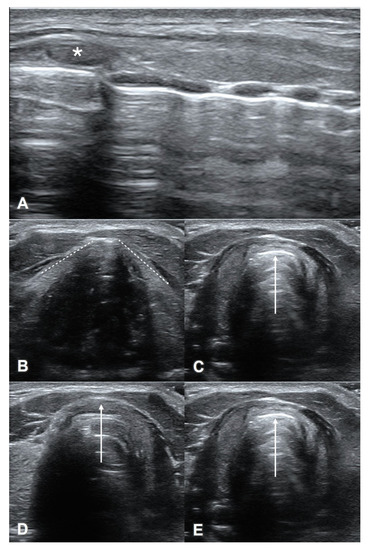 Point-of-Care Ultrasound in Airway Evaluation and Management: A ...