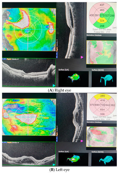 Bilateral Serous Retinal Detachment as a Complication of HELLP Syndrome