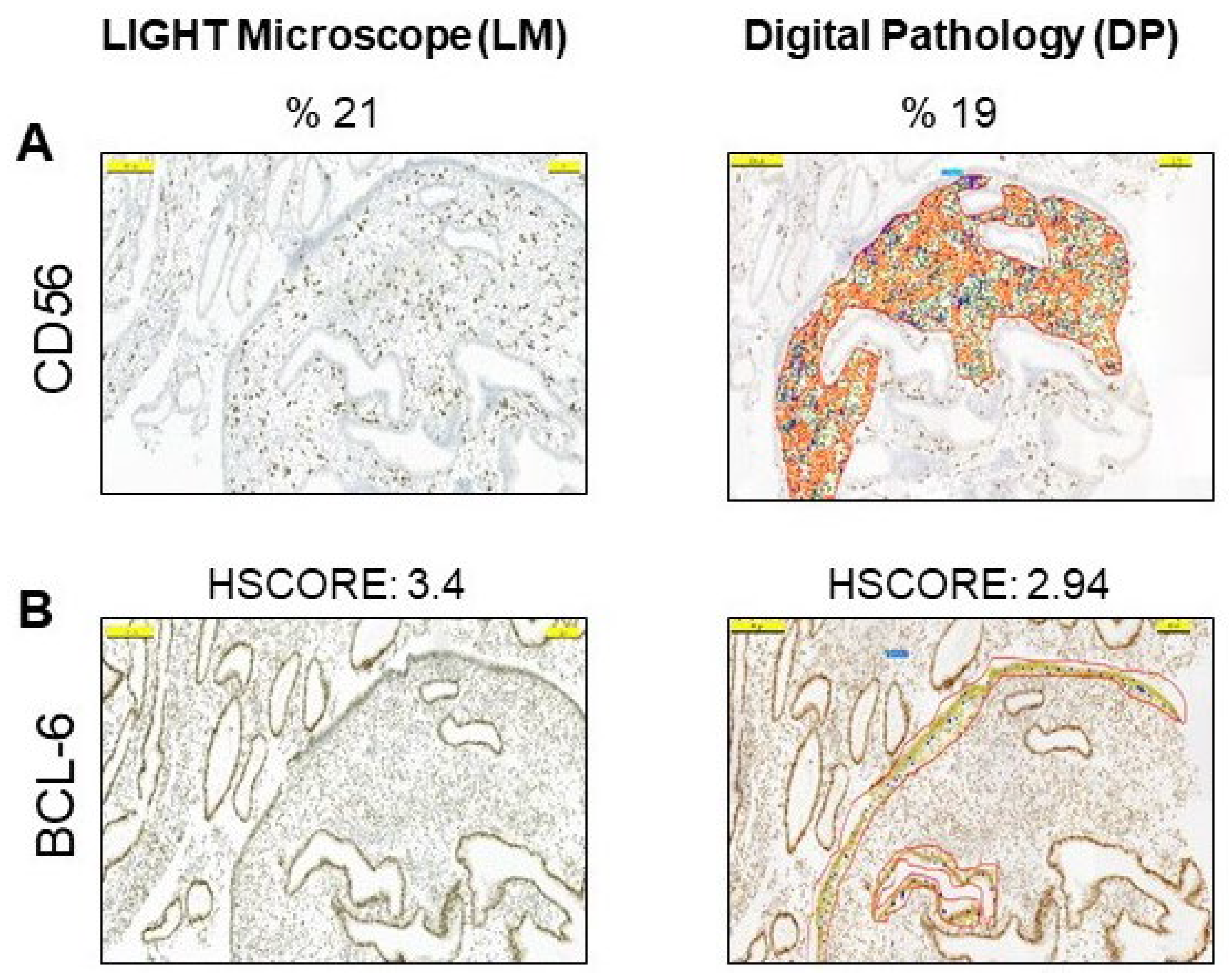 Endometrial Staining of CD56 (Uterine Natural Killer), BCL-6, and CD138 ...