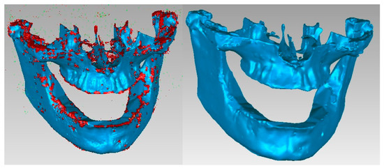 Using the Finite Element Method to Determine the Odonto-Periodontal ...