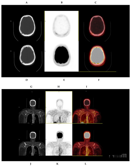 Multitracer PET/CT with [18F]Fluorodeoxiglucose and [18F]Fluorocholine ...
