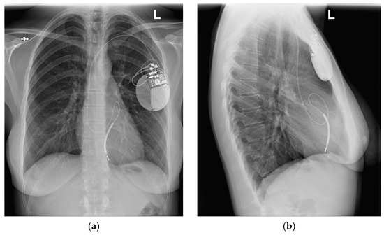 Application of Novel Technologies in Cardiac Electrotherapy to Prevent ...