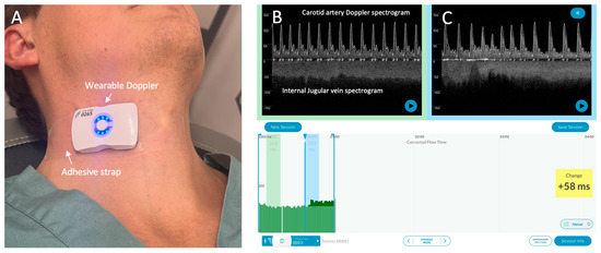 A Novel Spectral Index for Tracking Preload Change from a Wireless ...