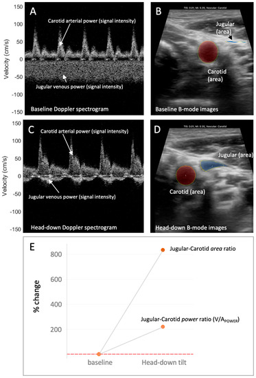 A Novel Spectral Index for Tracking Preload Change from a Wireless ...