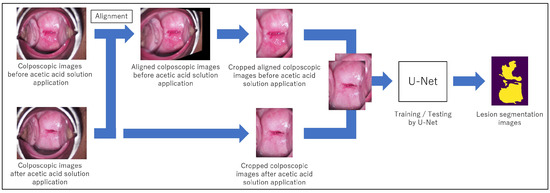 Diagnosis Assistance in Colposcopy by Segmenting Acetowhite Epithelium Using U-Net with Images ...