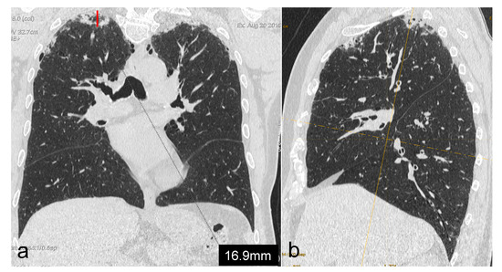 Pleuroparenchymal Fibroelastosis-like Lesions in Clinical Practice: A ...