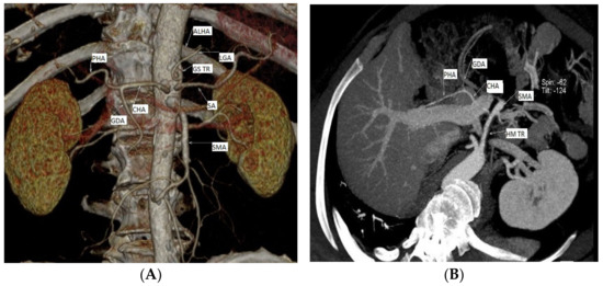 Clinical Consideration of Anatomical Variations in the Common Hepatic ...
