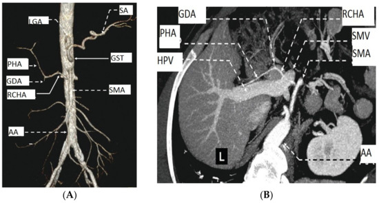 Clinical Consideration of Anatomical Variations in the Common Hepatic Arteries: An Analysis ...