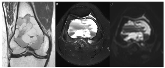 Pitfalls of Diffusion-Weighted Imaging: Clinical Utility of T2 Shine ...