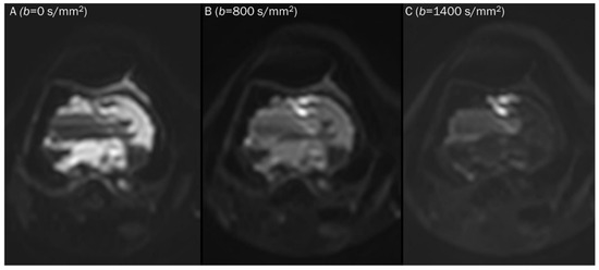 Pitfalls of Diffusion-Weighted Imaging: Clinical Utility of T2 Shine ...