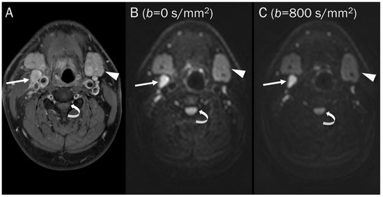 Pitfalls of Diffusion-Weighted Imaging: Clinical Utility of T2 Shine ...