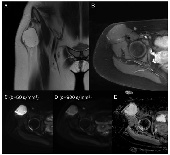 Pitfalls of Diffusion-Weighted Imaging: Clinical Utility of T2 Shine ...