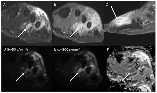 Pitfalls of Diffusion-Weighted Imaging: Clinical Utility of T2 Shine ...