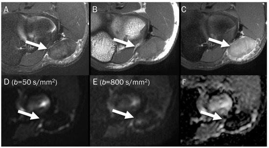 Pitfalls of Diffusion-Weighted Imaging: Clinical Utility of T2 Shine ...