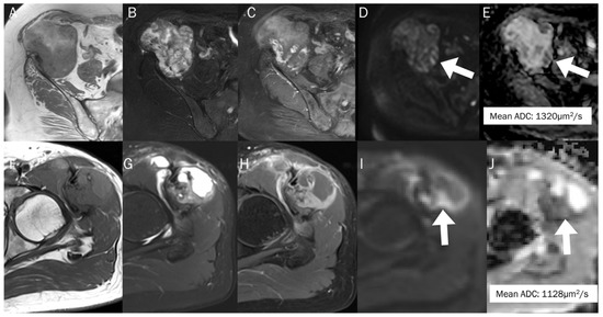 Pitfalls of Diffusion-Weighted Imaging: Clinical Utility of T2 Shine ...