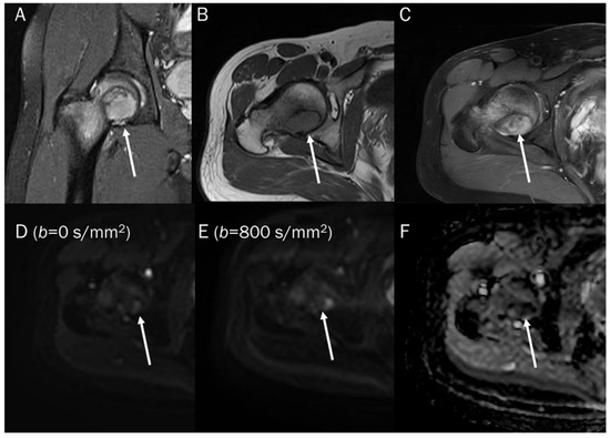Pitfalls of Diffusion-Weighted Imaging: Clinical Utility of T2 Shine ...