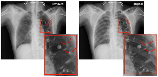 An Efficient and Robust Method for Chest X-ray Rib Suppression That ...