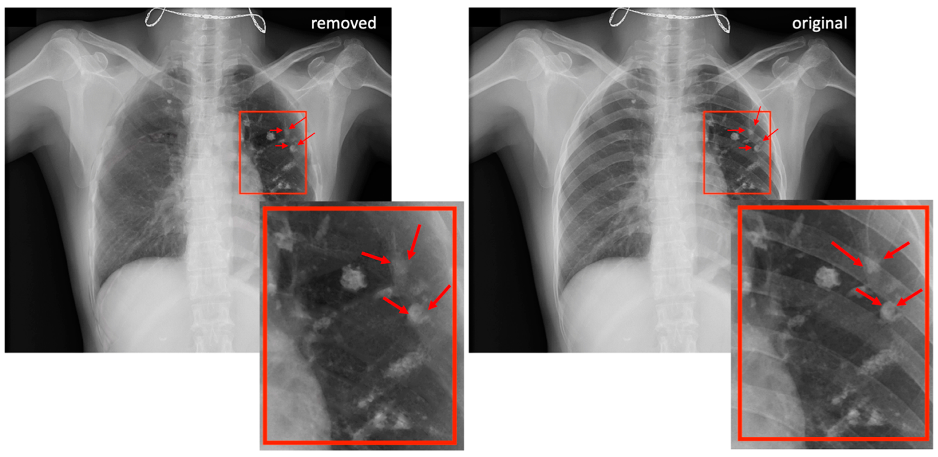 Diagnostics Free Full Text An Efficient And Robust Method For Chest X Ray Rib Suppression