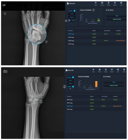 Clinical Validation of an Artificial Intelligence Model for Detecting ...