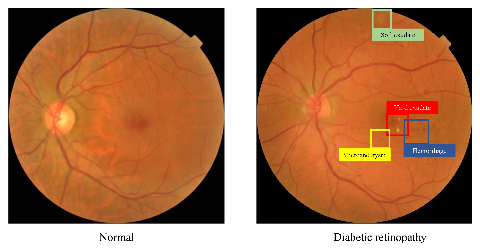Identifying the Key Components in ResNet-50 for Diabetic Retinopathy Grading from Fundus Images ...