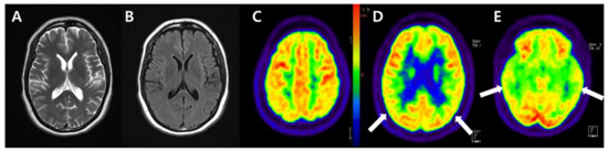 A Case Report of Early-Onset Alzheimer’s Disease Using 18F-FDG PET and ...