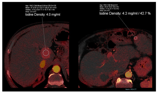 Spectral CT: Current Liver Applications