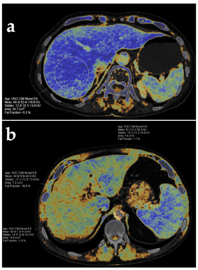 Spectral CT: Current Liver Applications