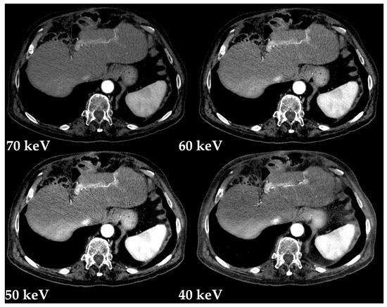 Spectral CT: Current Liver Applications