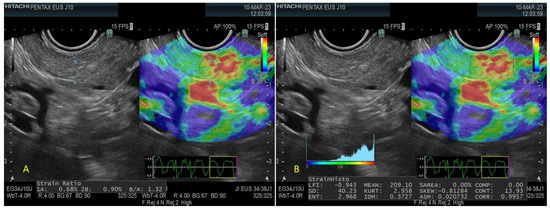 Endoscopic Ultrasound (EUS) Guided Elastography