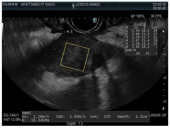 Endoscopic Ultrasound (EUS) Guided Elastography