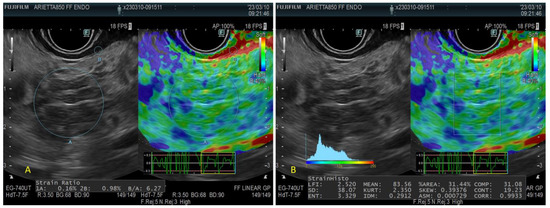 Endoscopic Ultrasound (EUS) Guided Elastography