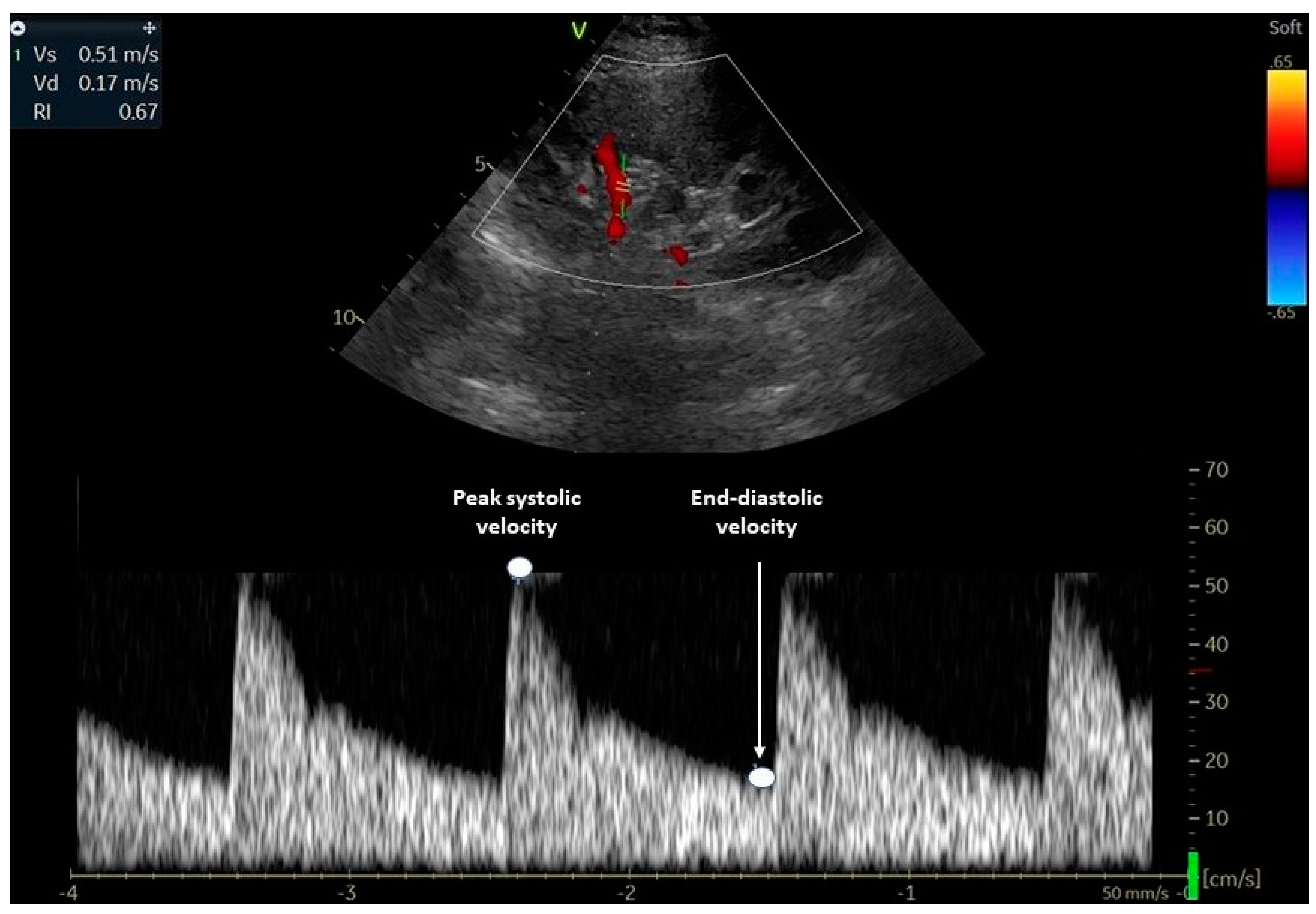 Abnormal Main Renal Artery Waveform