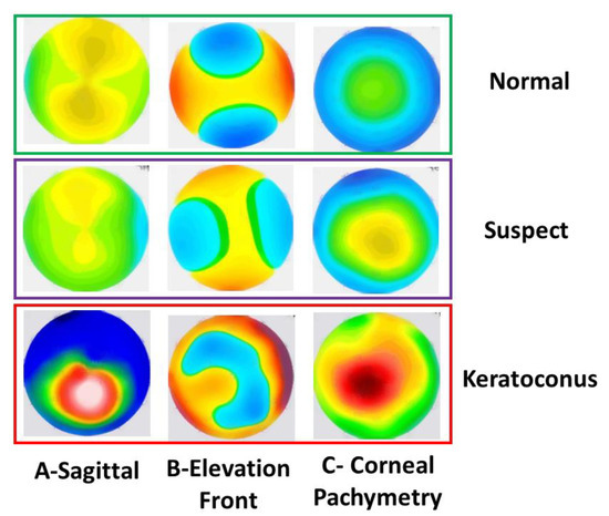 A Deep Feature Fusion of Improved Suspected Keratoconus Detection with Deep Learning