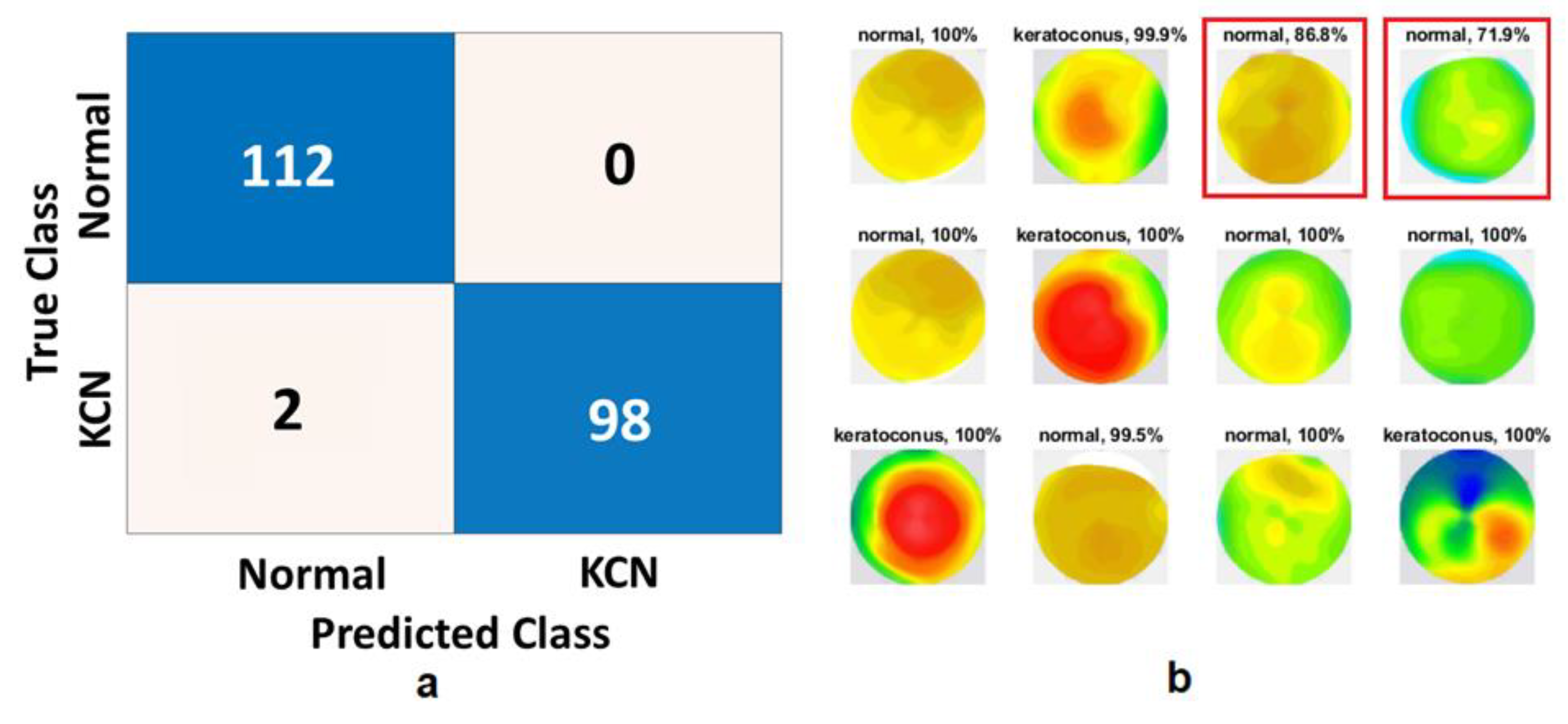 A Deep Feature Fusion of Improved Suspected Keratoconus Detection with Deep Learning