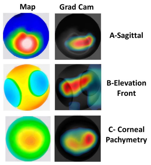 A Deep Feature Fusion of Improved Suspected Keratoconus Detection with Deep Learning