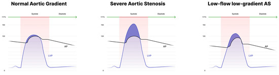 Is There Still a Role for Invasive Assessment of Aortic Gradient?